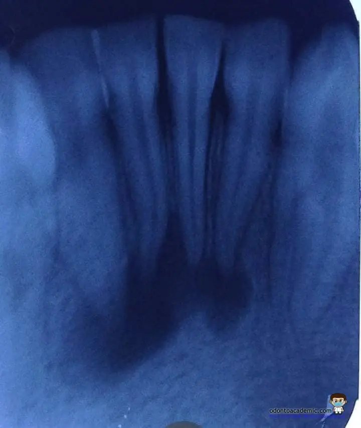 Lesión extra tisular, pulpitis irreversible aguda - Caso Clínico Dental ...